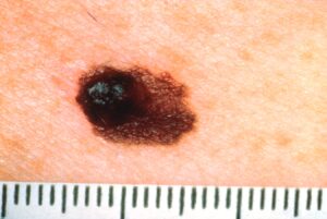 How to Detect Skin Cancer | Southern Cancer Center